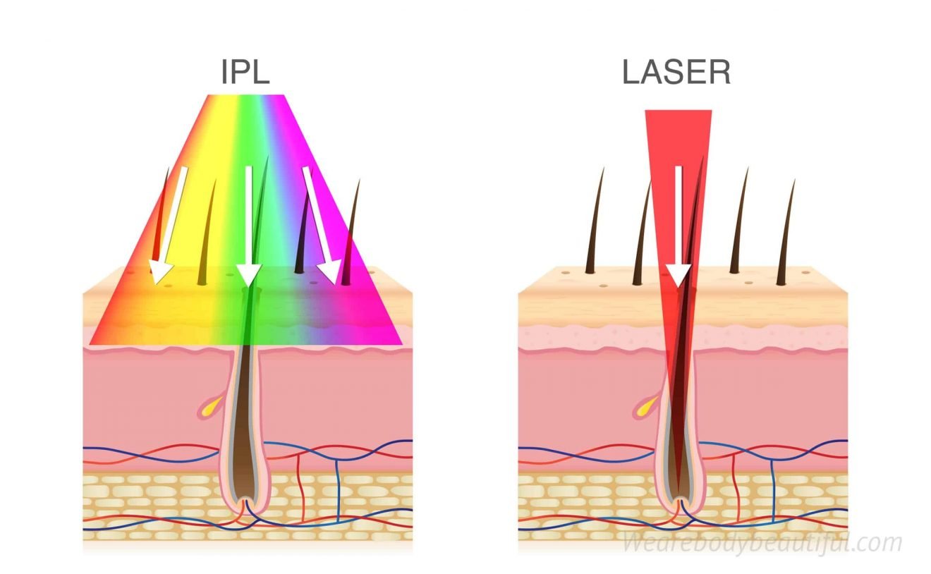 How does laser hair removal work on your hairs?
