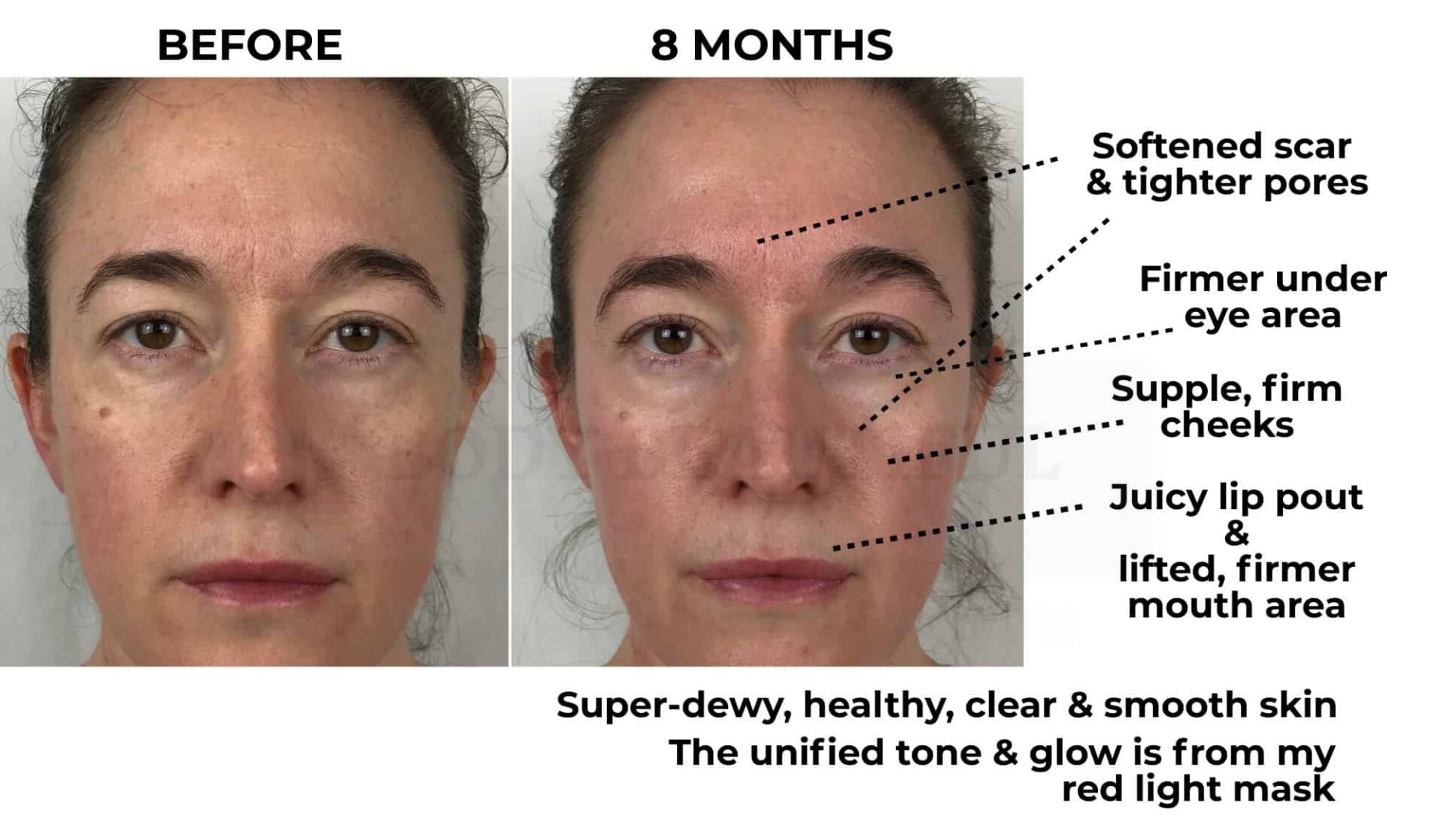 I quit! Microcurrent before and after photos