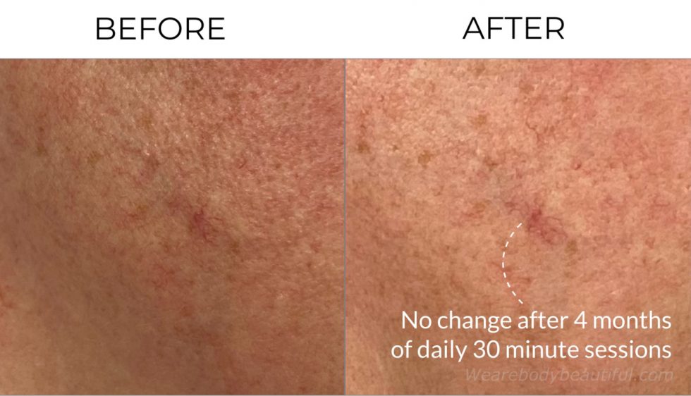 LYMA laser review: before and after photos - before and after real review